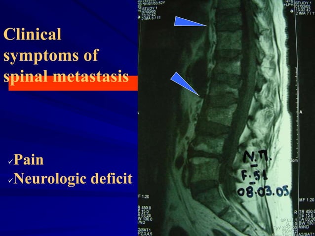 Metastatic Tumors of the Spinal Column: Diagnosis and Treatment | PPT