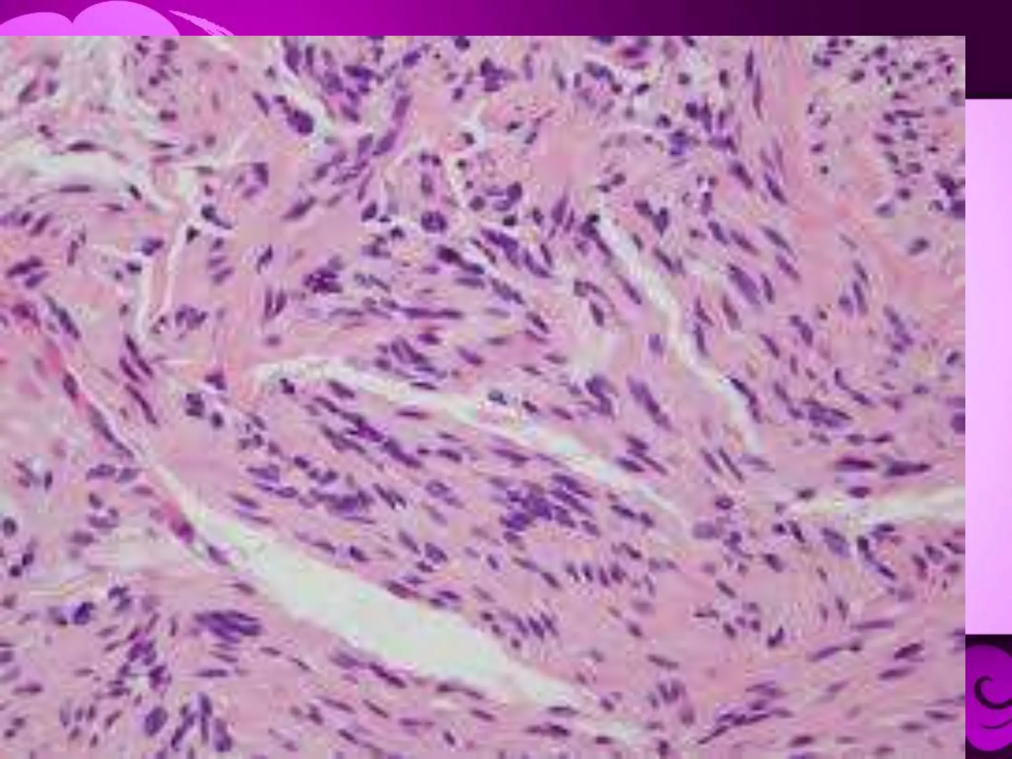 Tumors-of-nerves-and-muscles(Part-1)-2020819142700.pptx