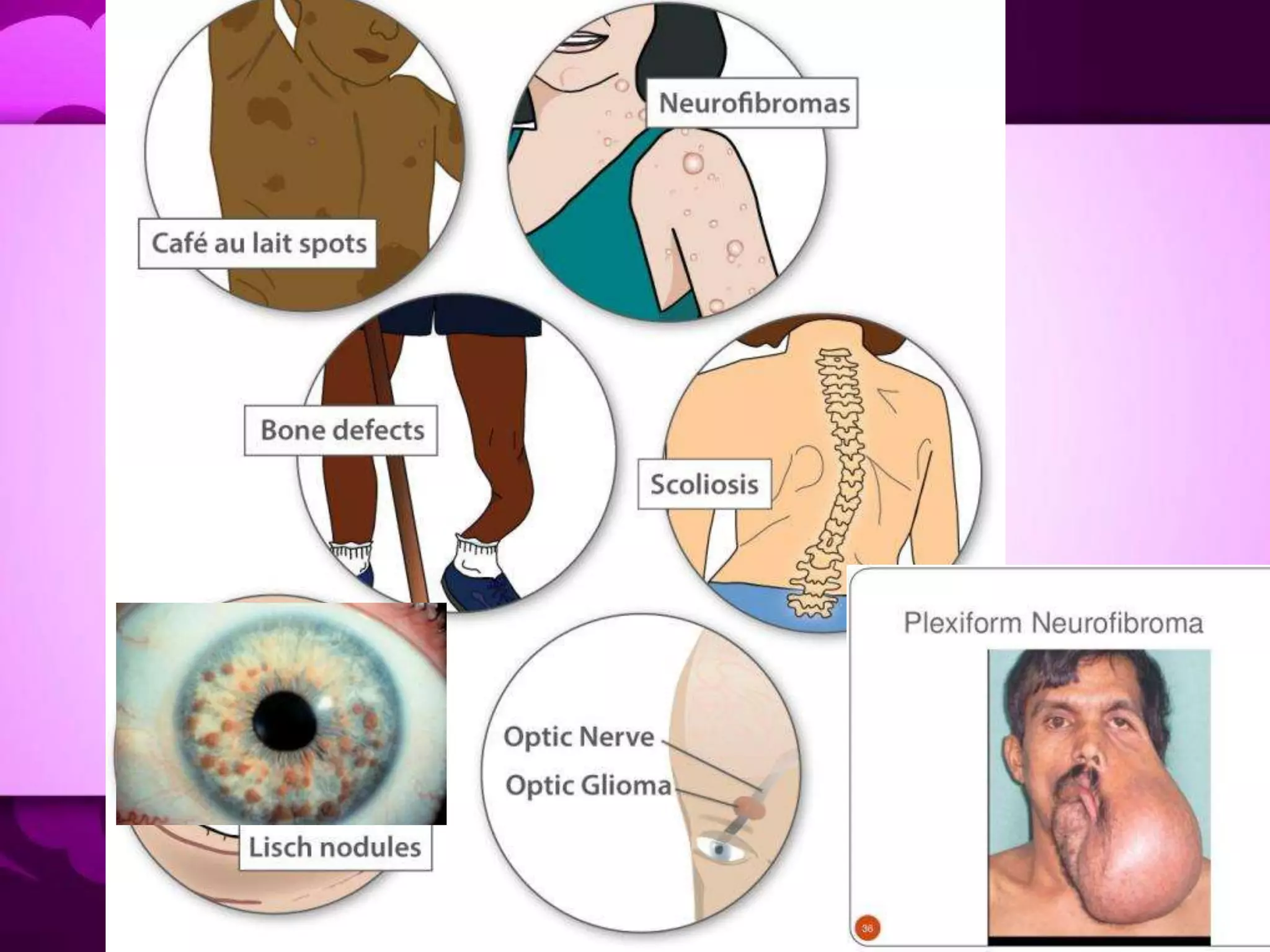 Tumors-of-nerves-and-muscles(Part-1)-2020819142700.pptx