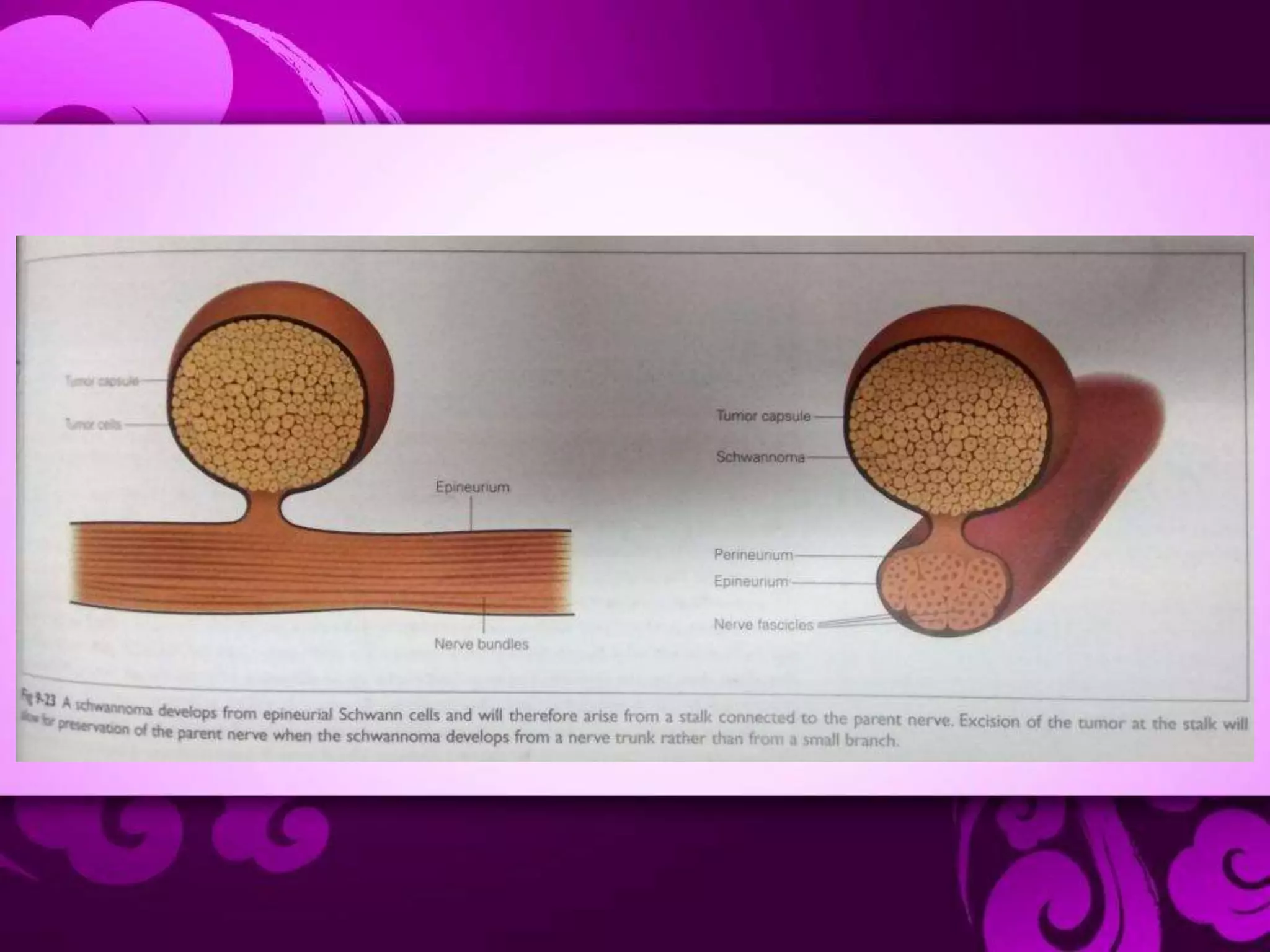 Tumors-of-nerves-and-muscles(Part-1)-2020819142700.pptx