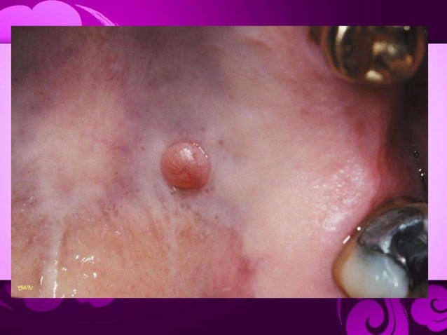 Tumors-of-nerves-and-muscles(Part-1)-2020819142700.pptx