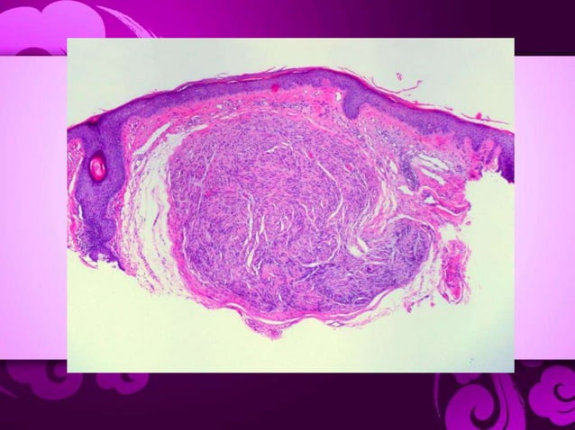 Tumors-of-nerves-and-muscles(Part-1)-2020819142700.pptx
