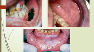 Tumors and Precancerous Lesions and how to distinguish them | PPTX