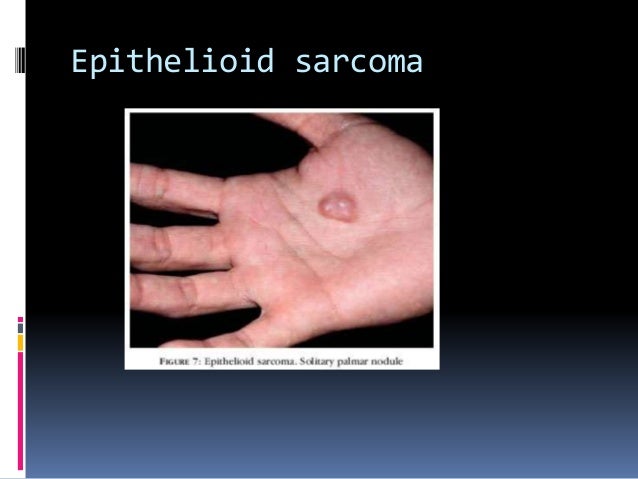 Tumors and tumorous conditions of the hand
