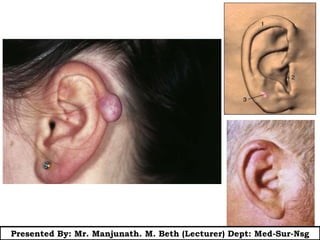 Tumors (ears) | PPTX