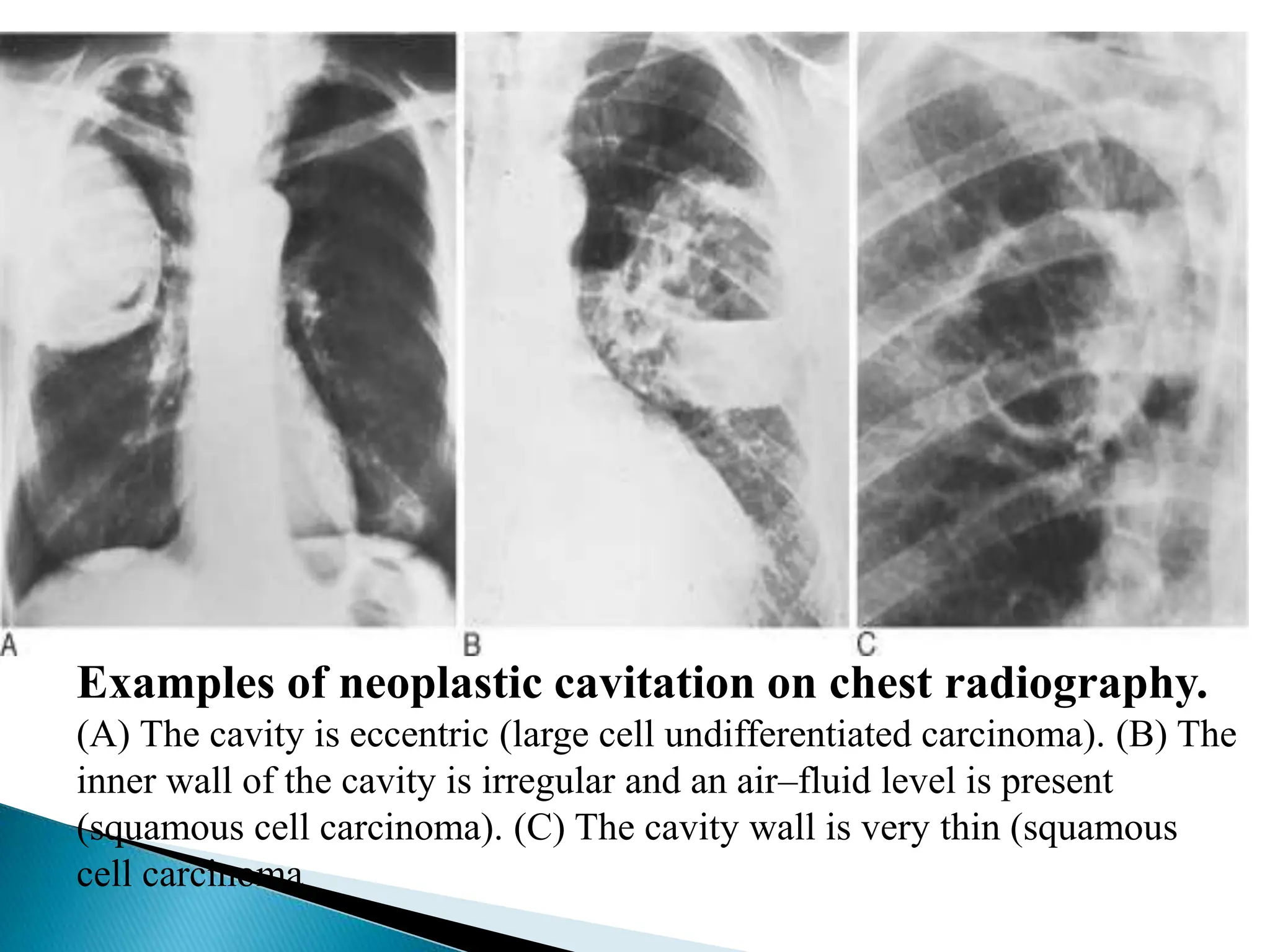 TUMORS & METASTASIS chest diaease for physiotherapy.pptx