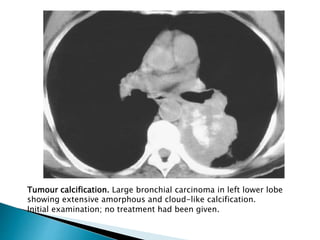 TUMORS & METASTASIS chest diaease for physiotherapy.pptx