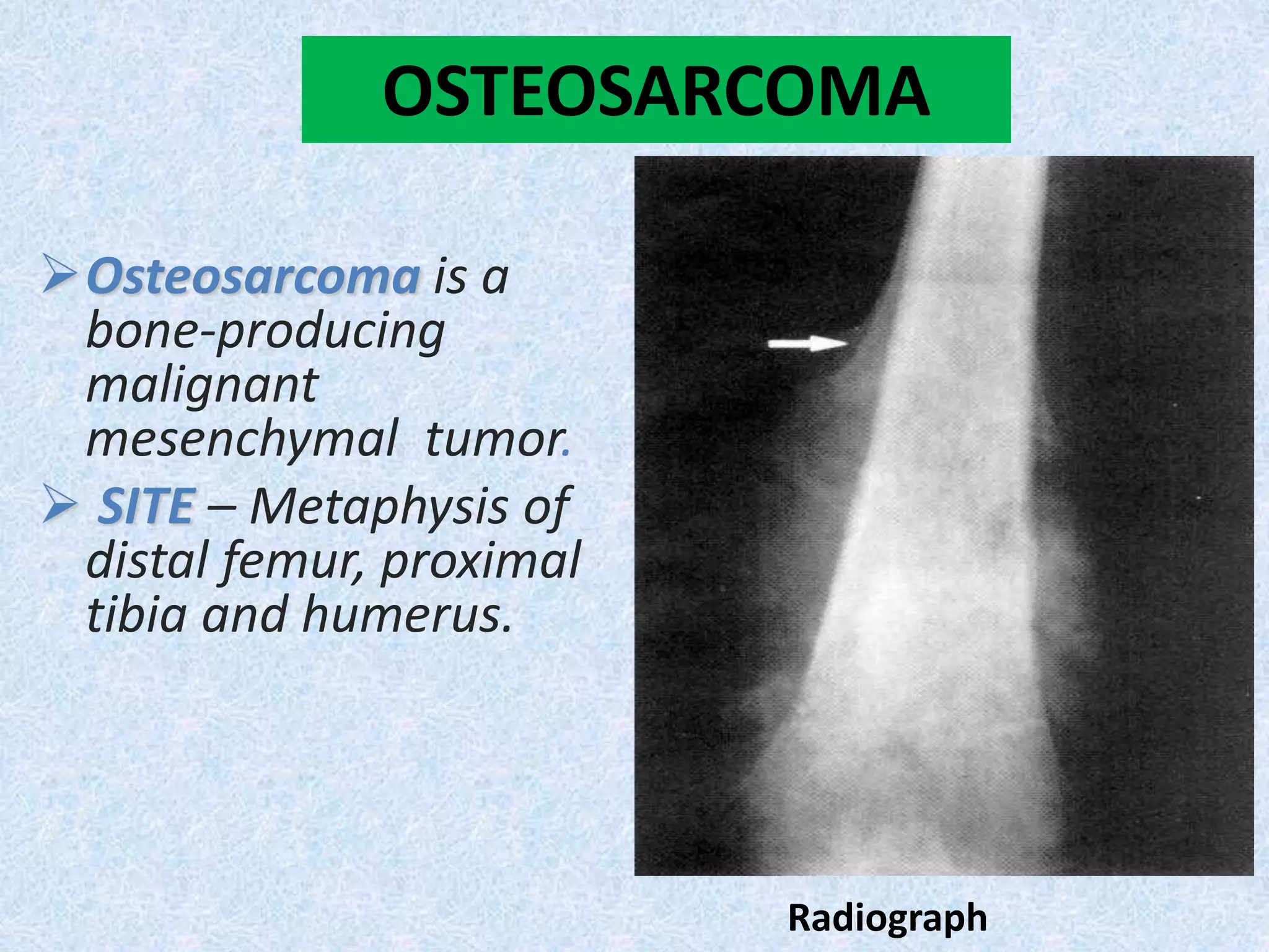 Tumors of bone | PPTX