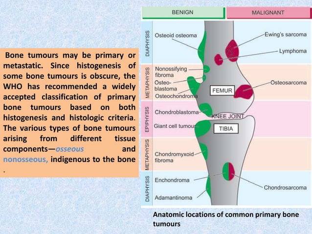 Tumors of bone | PPTX
