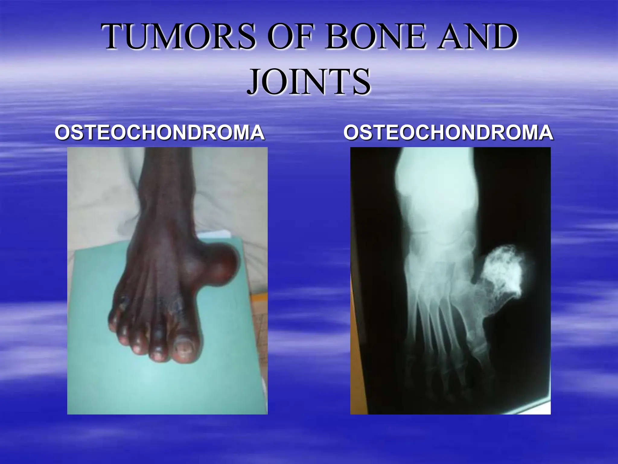 TUMORS OF BONE AND JOINTS IN ORTHOPAEDICS (4).ppt