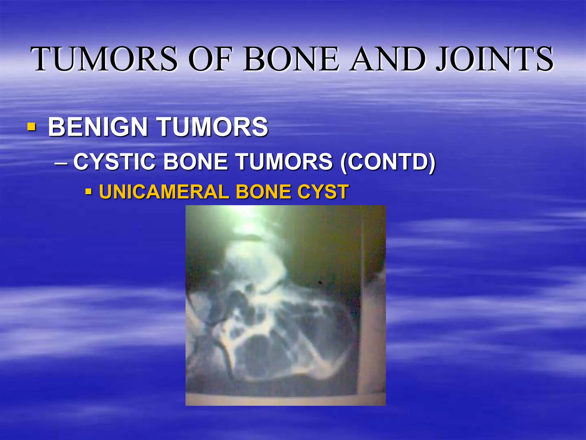 TUMORS OF BONE AND JOINTS IN ORTHOPAEDICS (4).ppt