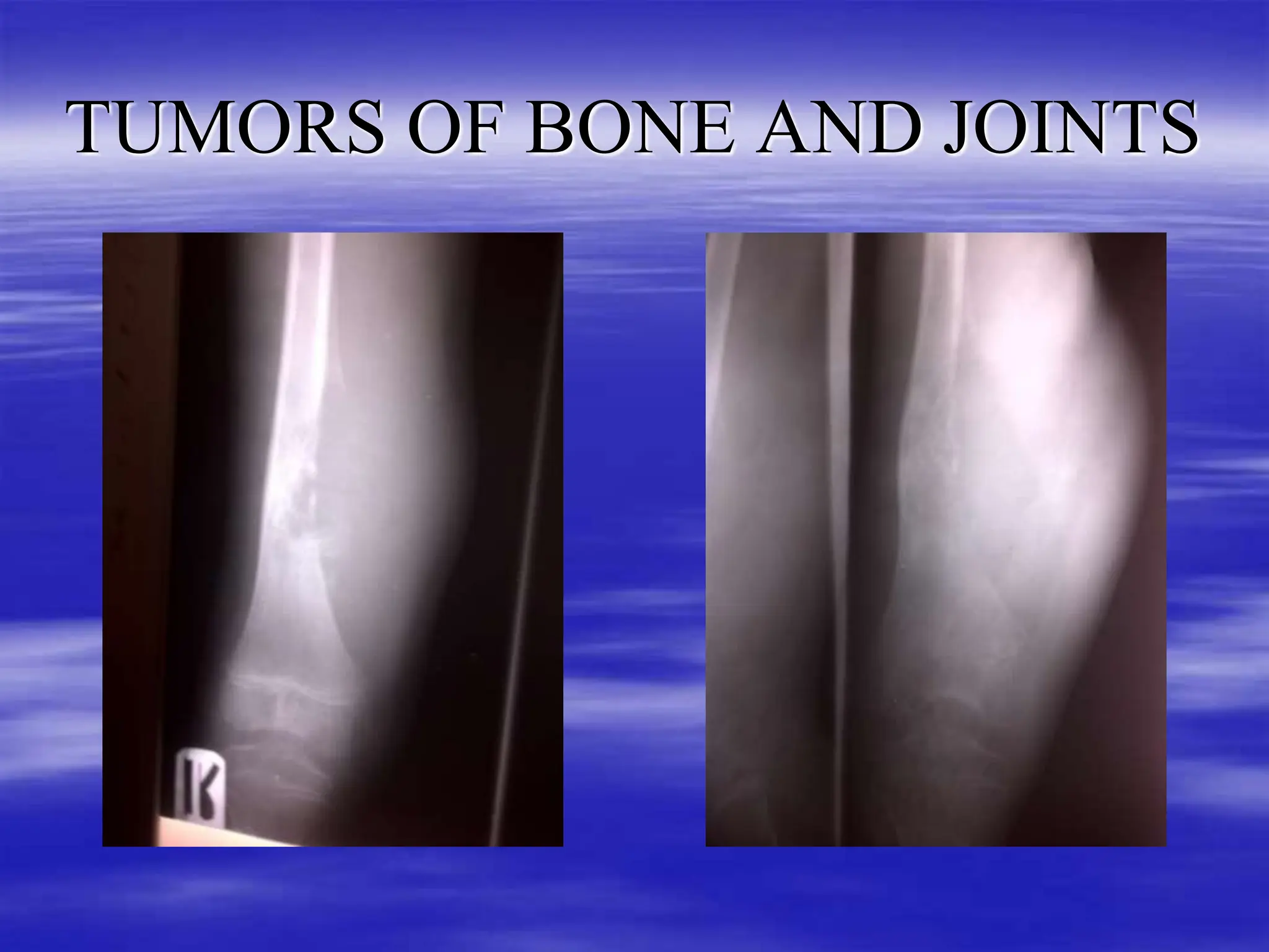 TUMORS OF BONE AND JOINTS IN ORTHOPAEDICS (4).ppt