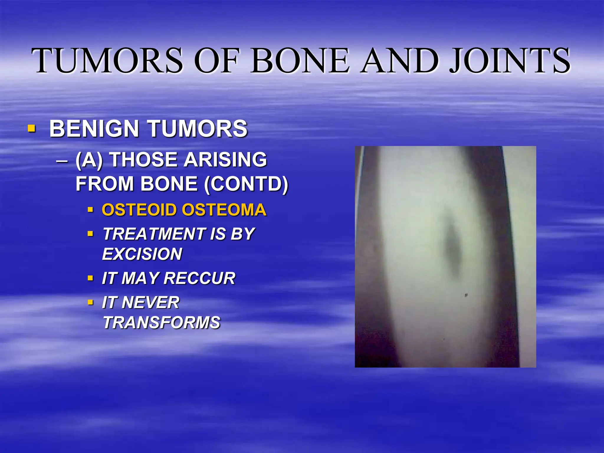 TUMORS OF BONE AND JOINTS IN ORTHOPAEDICS (4).ppt