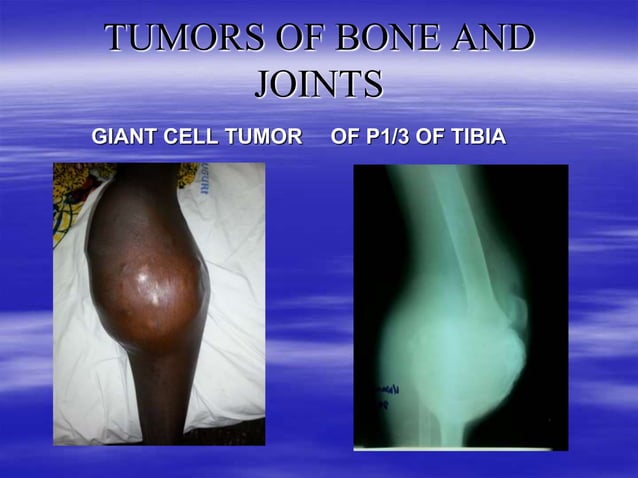 TUMORS OF BONE AND JOINTS IN ORTHOPAEDICS (4).ppt