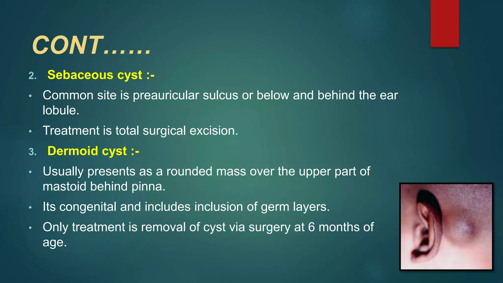 TUMORS OF EAR | PPTX