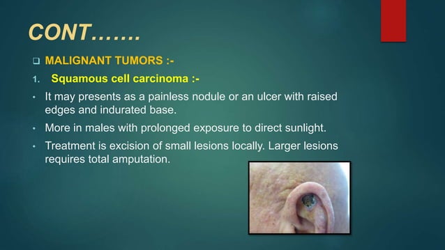 TUMORS OF EAR | PPTX