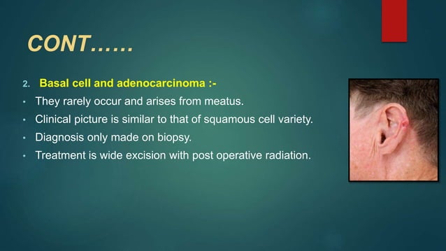 TUMORS OF EAR | PPTX