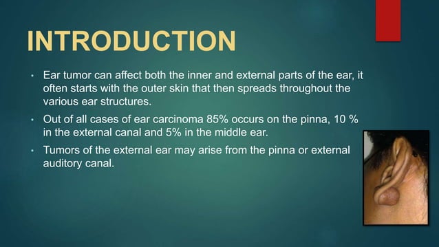 TUMORS OF EAR | PPTX