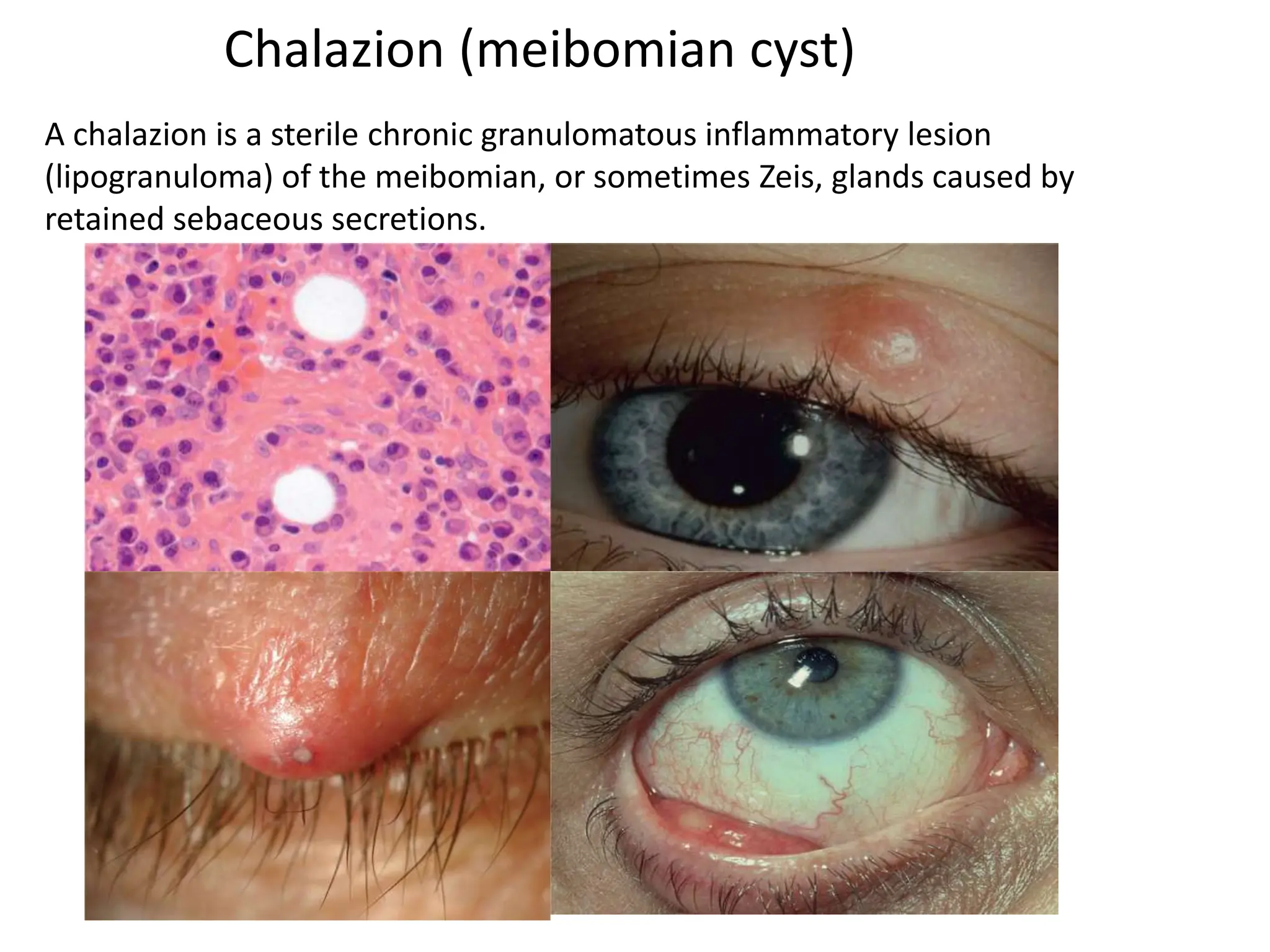 Tumours of Eyelid- ophthalmology malignant and benign | PPTX