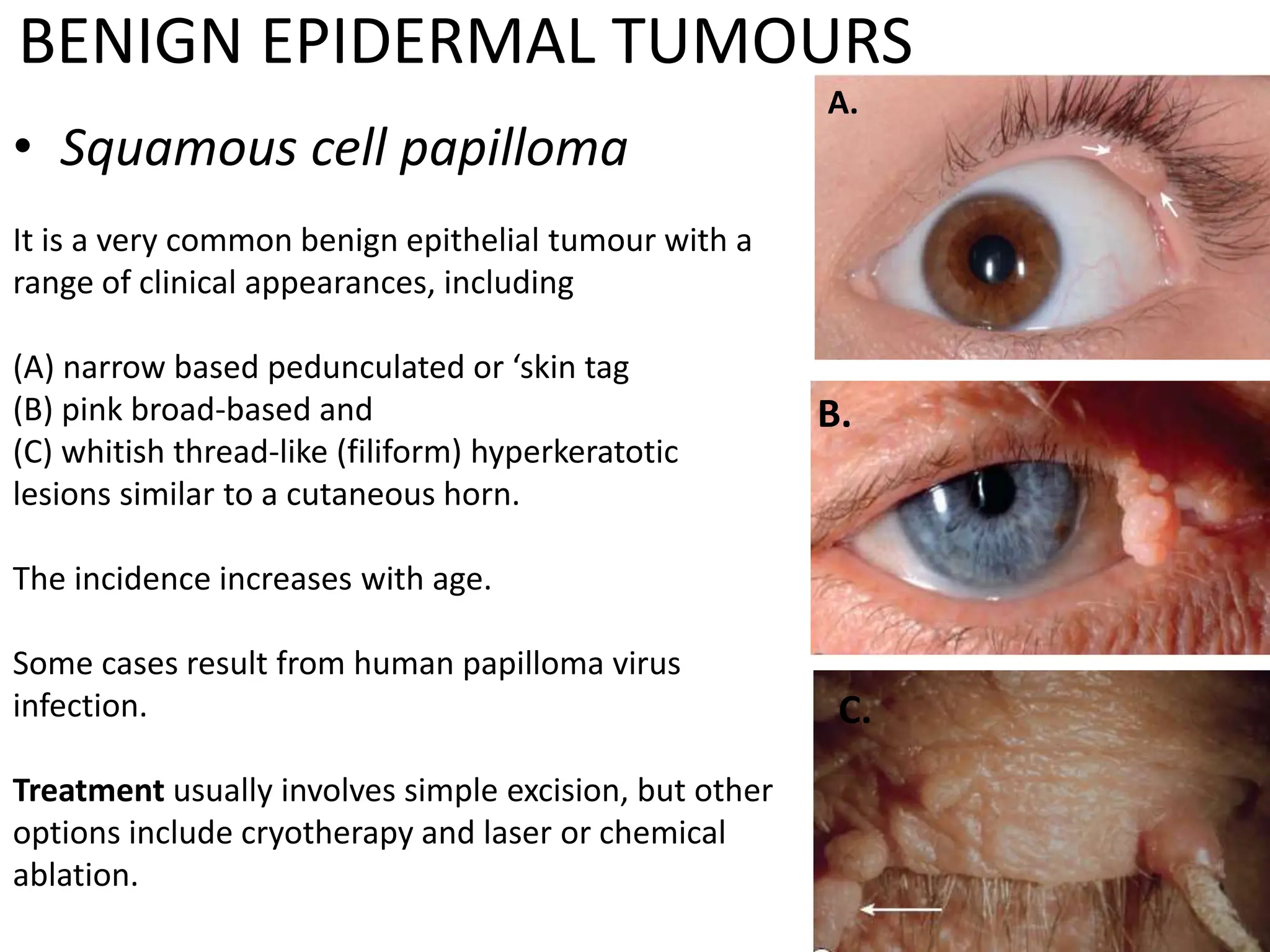 Tumours of Eyelid- ophthalmology malignant and benign | PPTX
