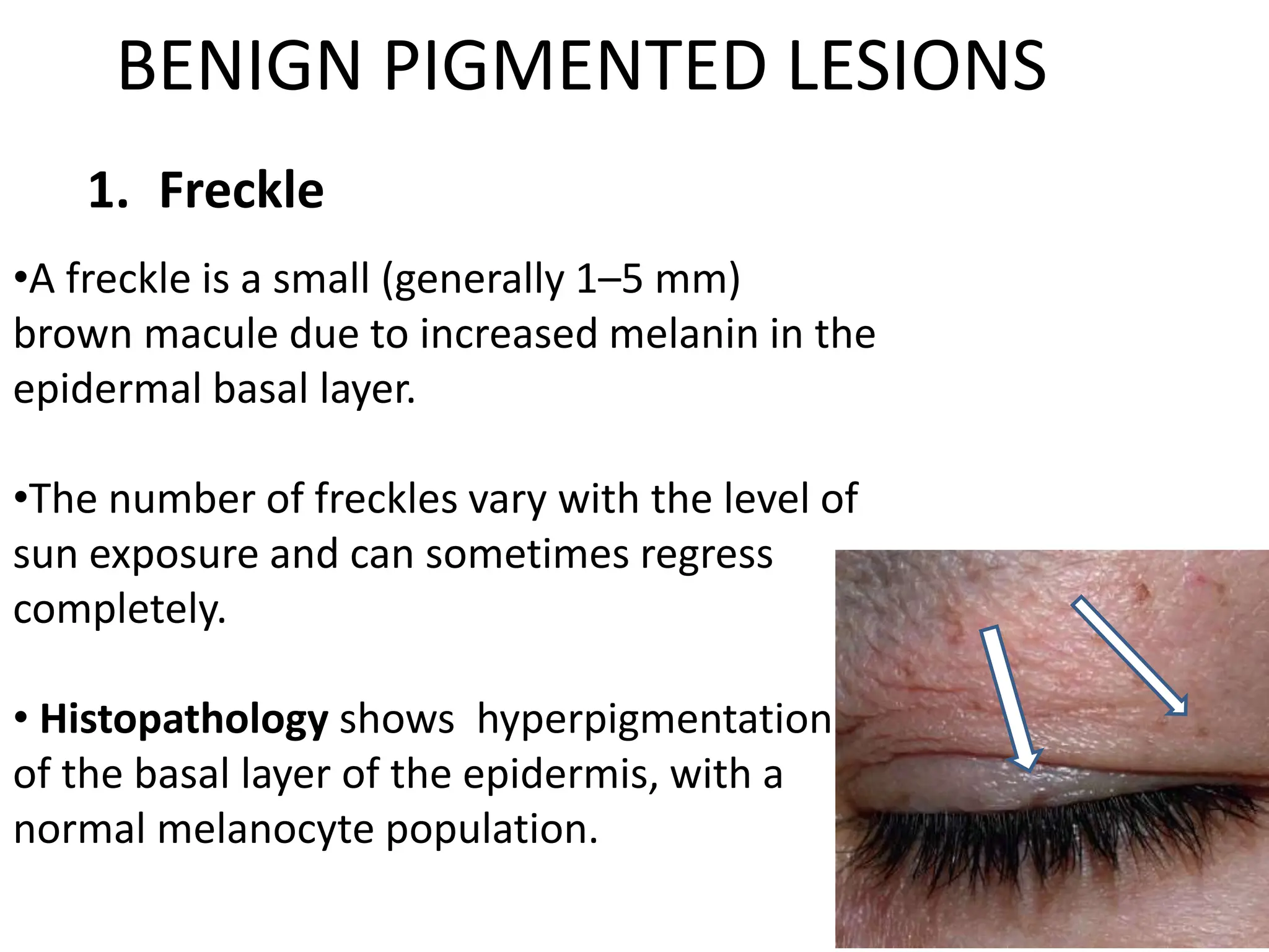 Tumours of Eyelid- ophthalmology malignant and benign | PPTX