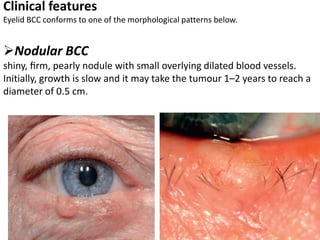 Tumours of Eyelid- ophthalmology malignant and benign | PPTX