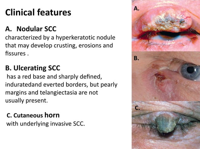 Tumours of Eyelid- ophthalmology malignant and benign | PPTX