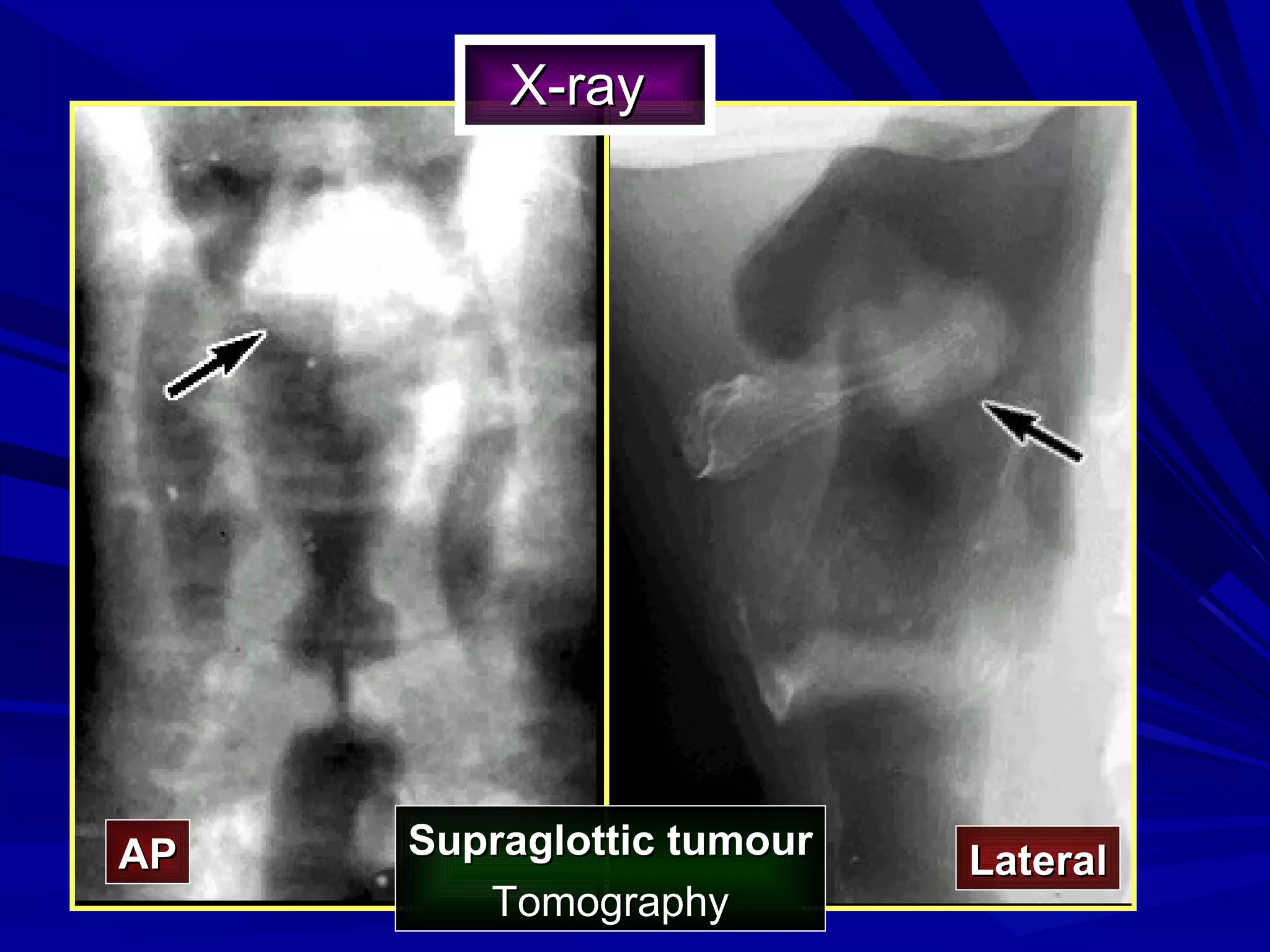 E.N.T,Tumors of larynx.(dr.usif chalabe) | PPT | Ear, Nose and Throat ...