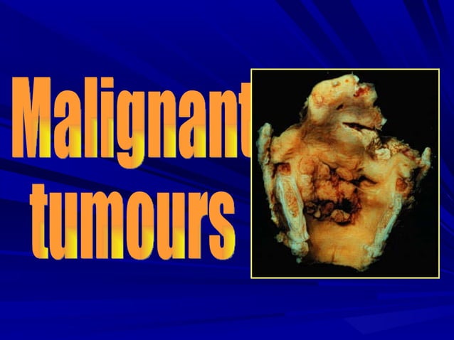 E.N.T,Tumors of larynx.(dr.usif chalabe) | PPT | Ear, Nose and Throat ...