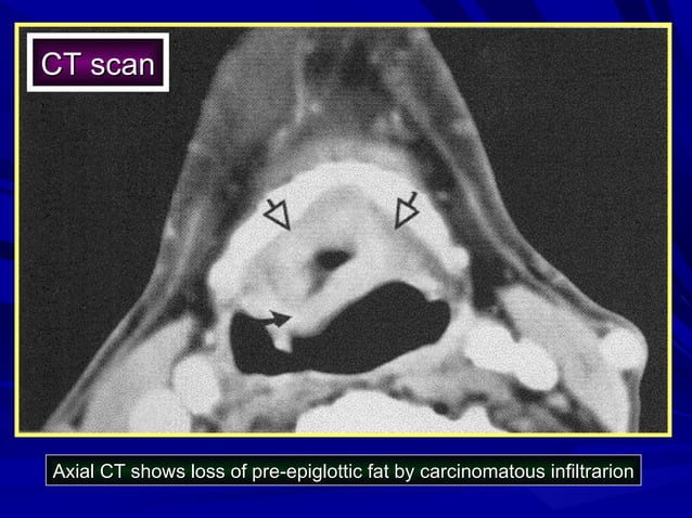 E.N.T,Tumors of larynx.(dr.usif chalabe) | PPT | Ear, Nose and Throat ...