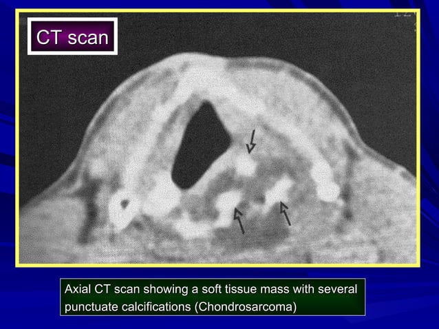 E.N.T,Tumors of larynx.(dr.usif chalabe) | PPT | Ear, Nose and Throat ...