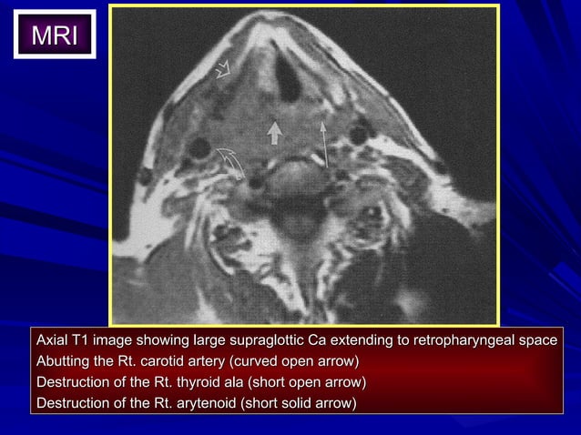 E.N.T,Tumors of larynx.(dr.usif chalabe) | PPT | Ear, Nose and Throat ...