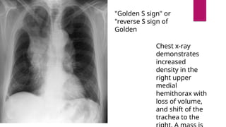 Tumors of Lungs (Respiratory System) ppt | PPTX