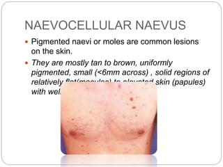 TUMORS OF MELANIN FORMING TISSUE.pptx