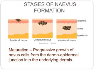 TUMORS OF MELANIN FORMING TISSUE.pptx