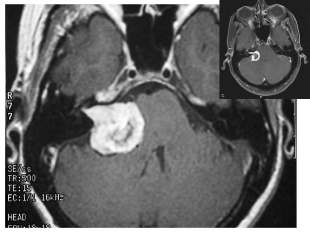 Tumors of middle and inner ear dr.sithanandha kumar 14.03.2016