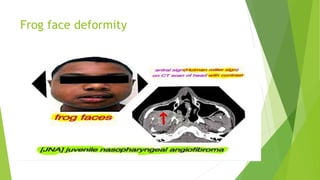 Tumors of nasopharynx.pptx