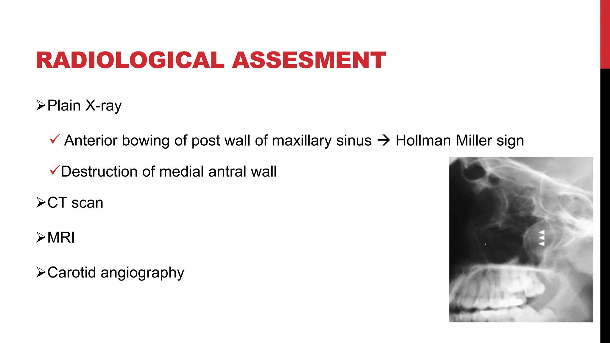TUMORS OF NASOPHARYNX,etiology ,pathology ,treatment | PPTX