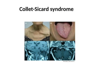 TUMORS OF NASOPHARYNX (1);;;;;; (3).pptx