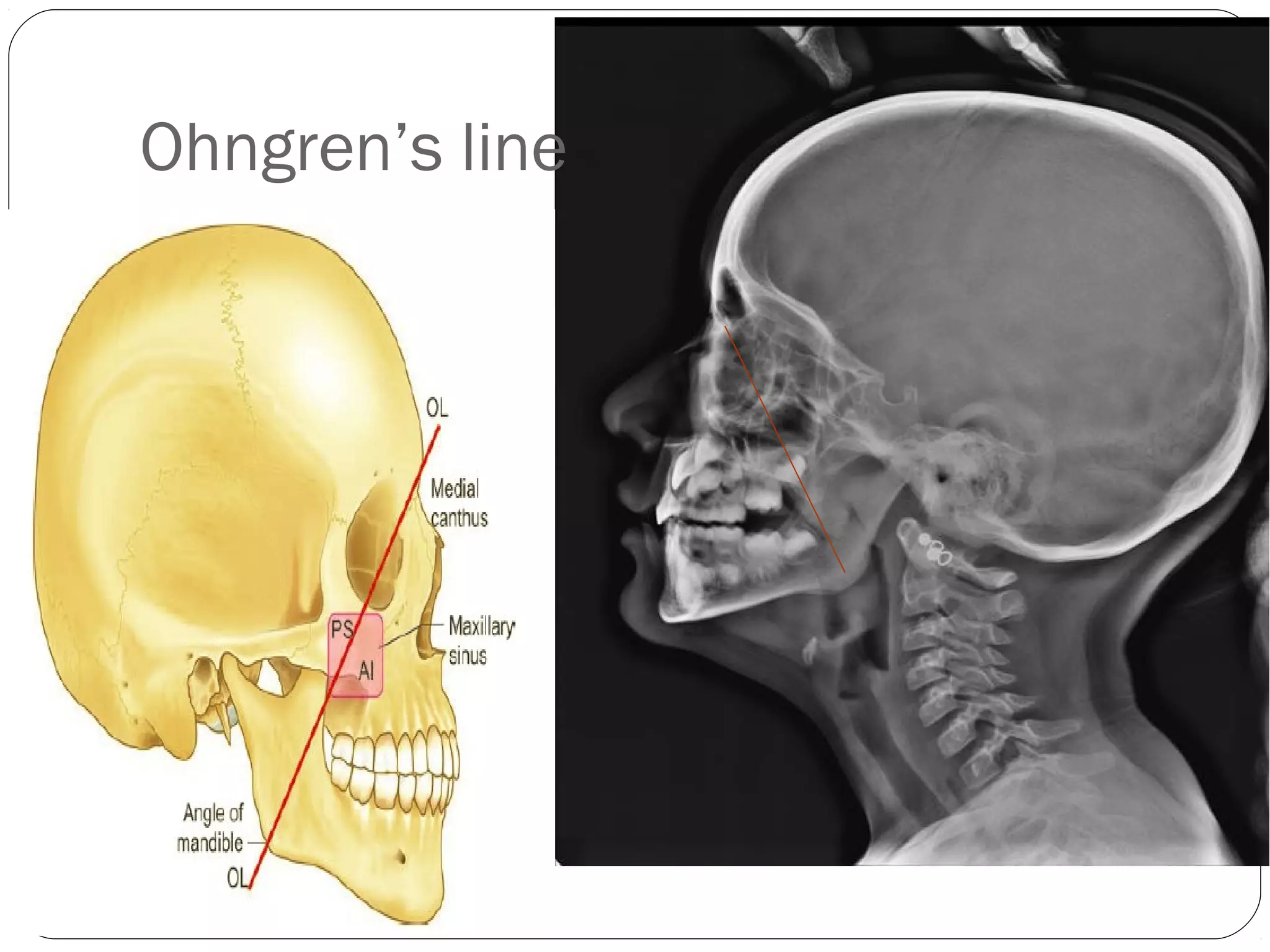 Tumors of nose and paranasal sinus dr.sithanandhakumar -13.06.16