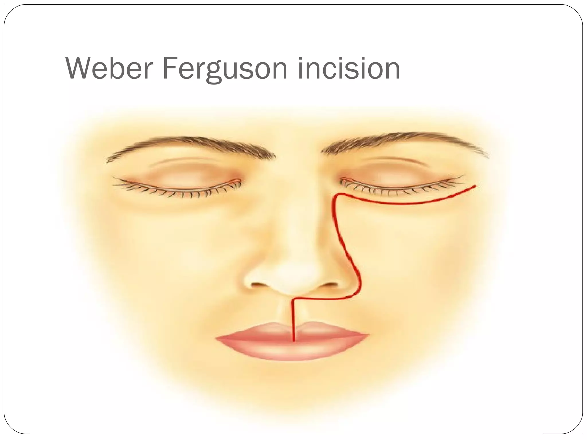 Tumors of nose and paranasal sinus dr.sithanandhakumar -13.06.16
