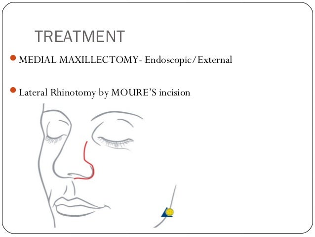 Tumors of nose and paranasal sinus dr.sithanandhakumar -13.06.16