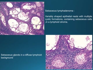 Tumors of salivary gland | PPTX
