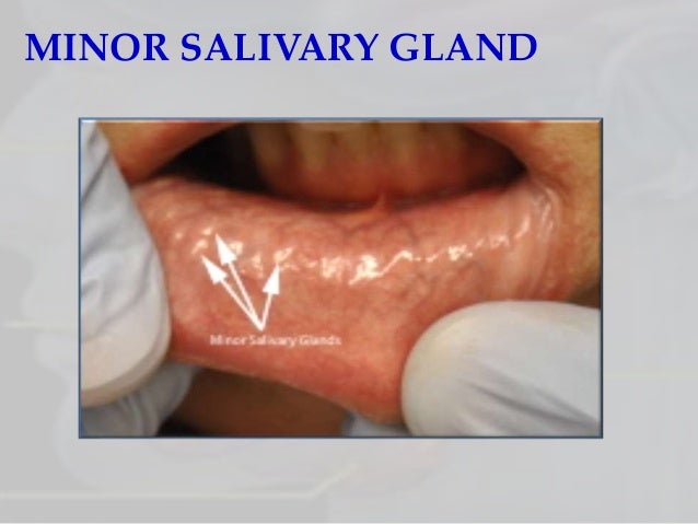 Salivary Gland Tumor
