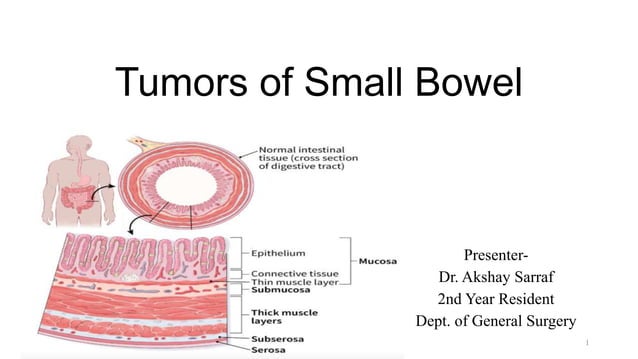Tumors of small bowel.pptx | Digestive Disorders | Diseases and Conditions