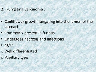 Tumors of stomach | PPT