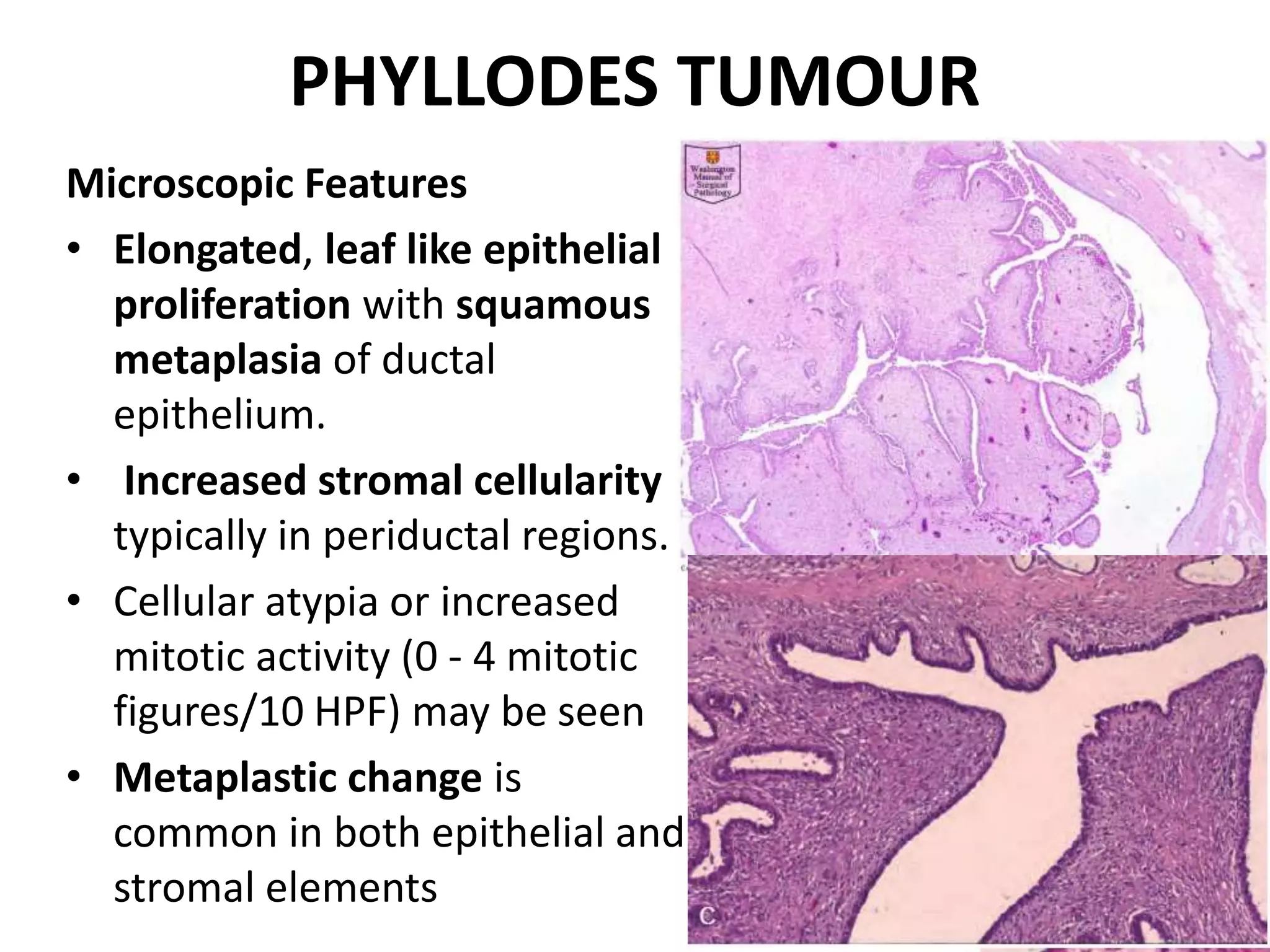 Tumors of the breast | PPTX