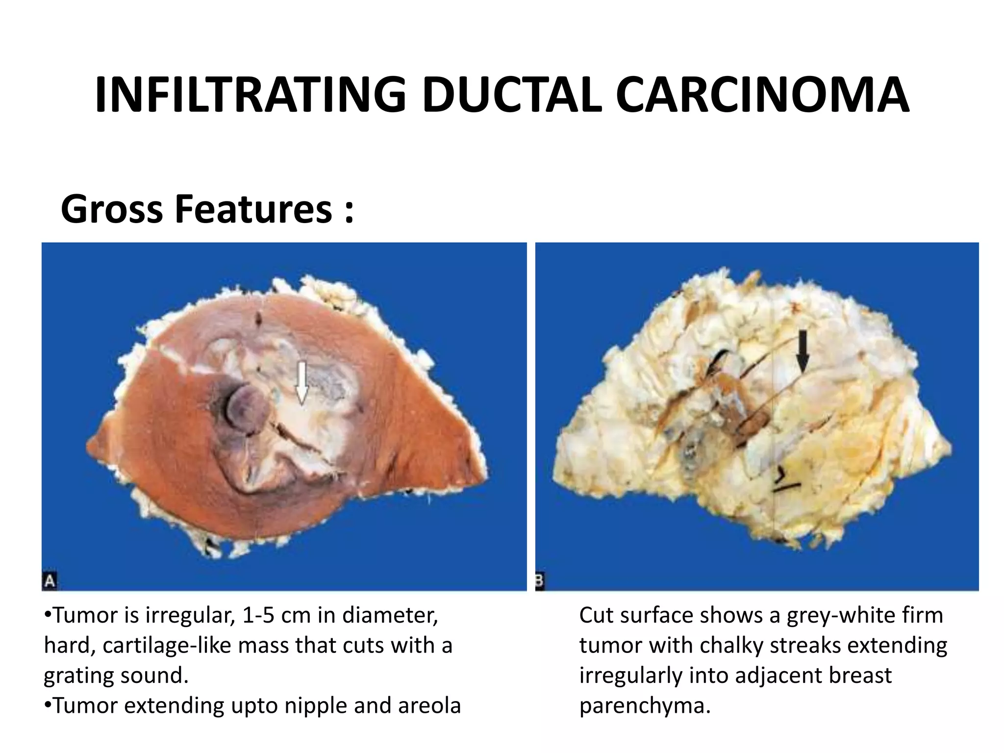 Tumors of the breast | PPTX