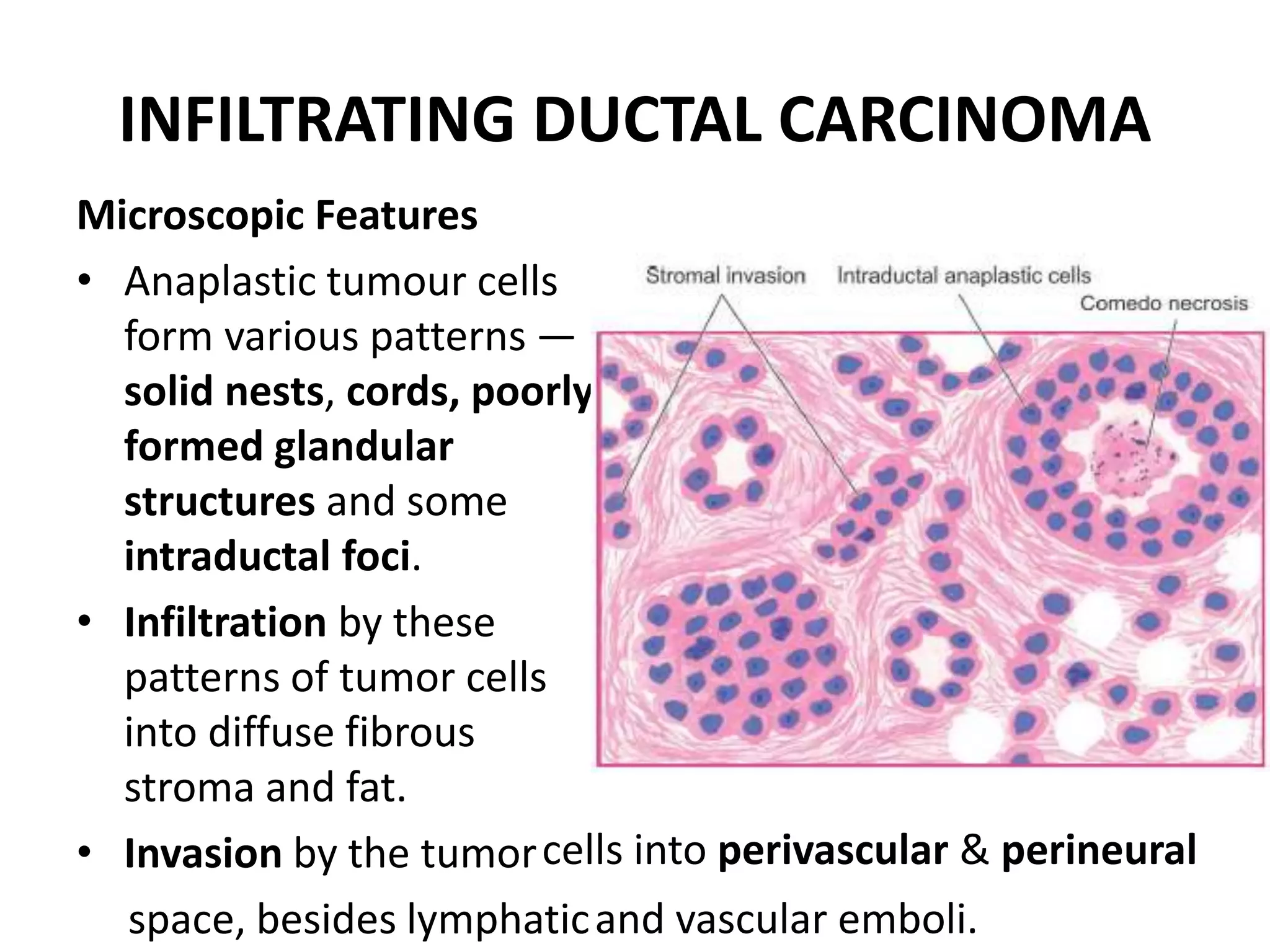 Tumors of the breast | PPTX