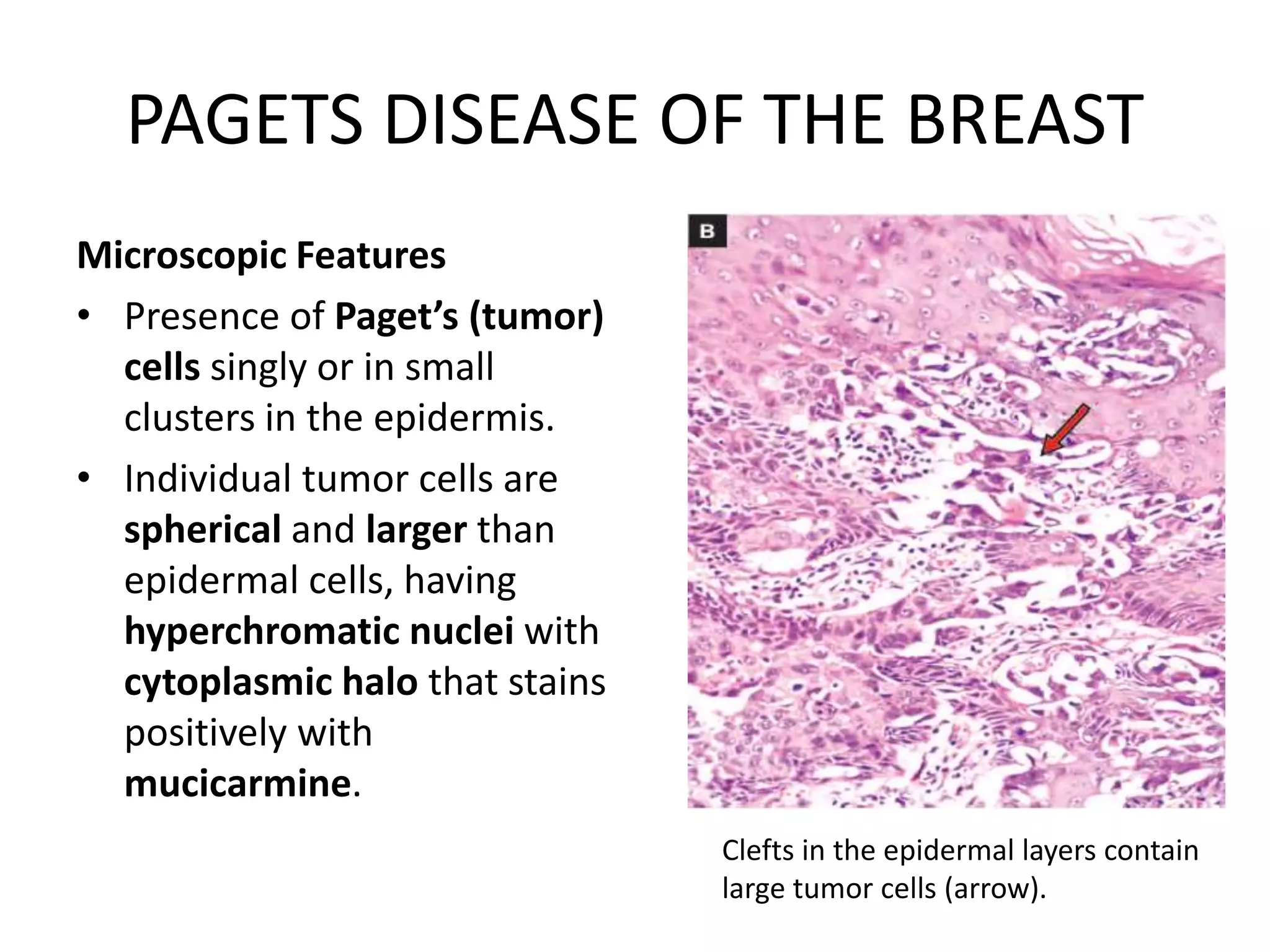 Tumors of the breast | PPTX
